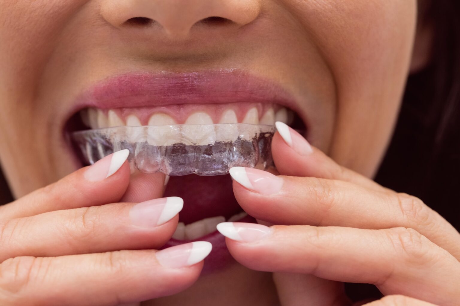 Invisible Retainers vs. Traditional - Which Suits You Best?